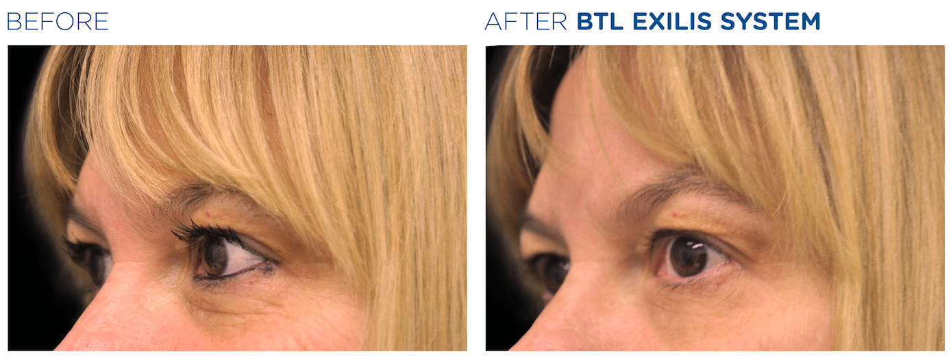 EXILIS ULTRA 360 is a world-leading technology for non-invasive body ...