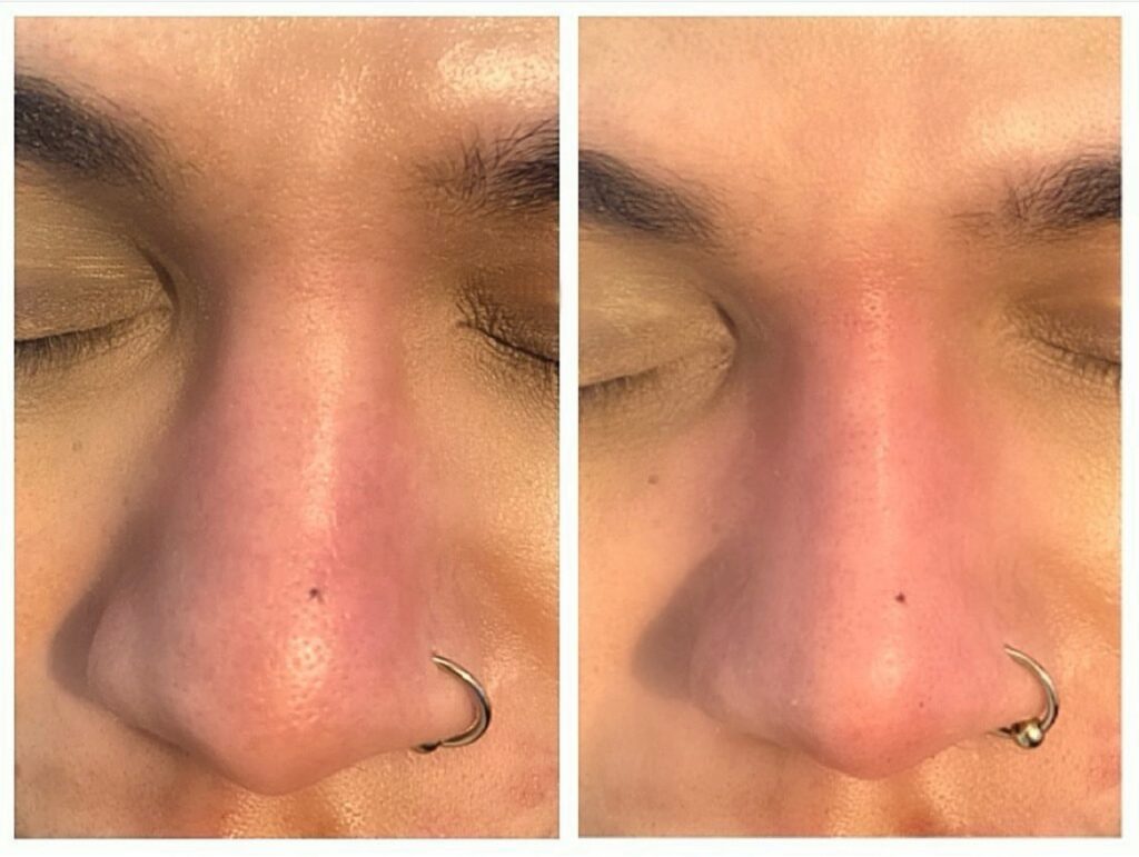 Nose Filler - London Beauty Clinic