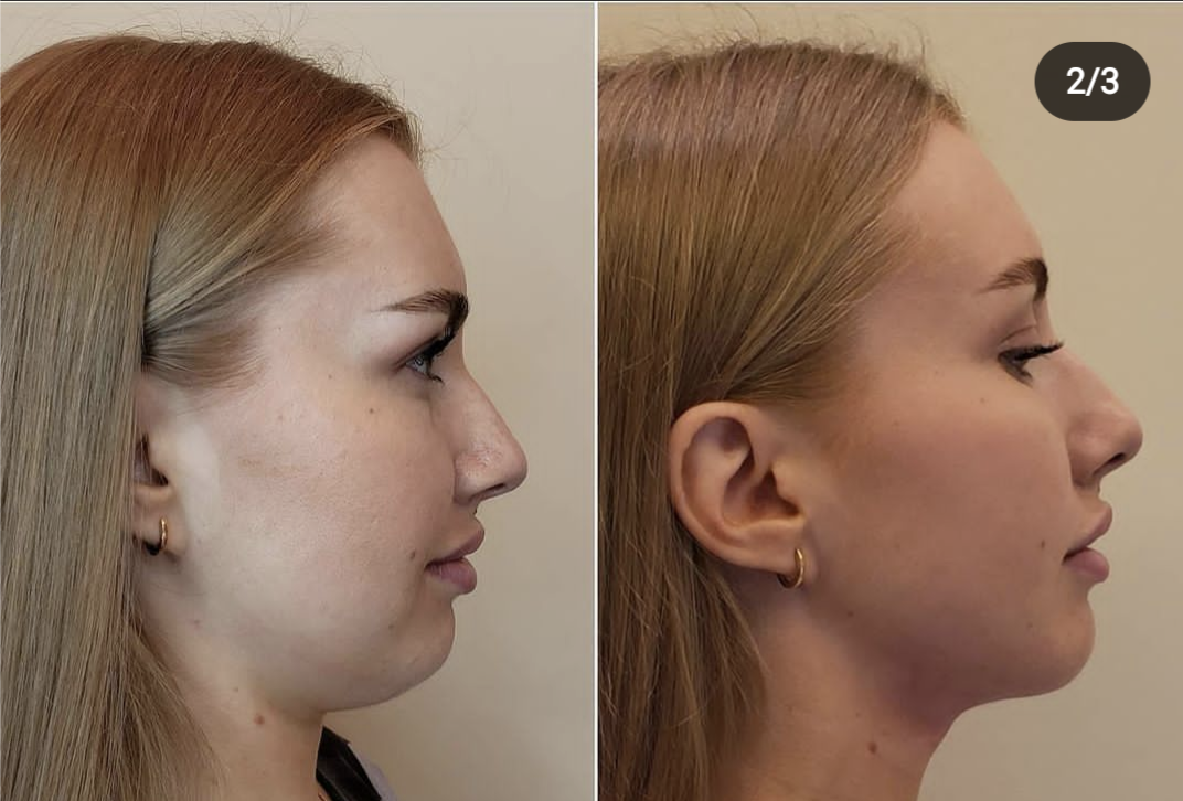Masseter Slimming London - London Beauty Clinic