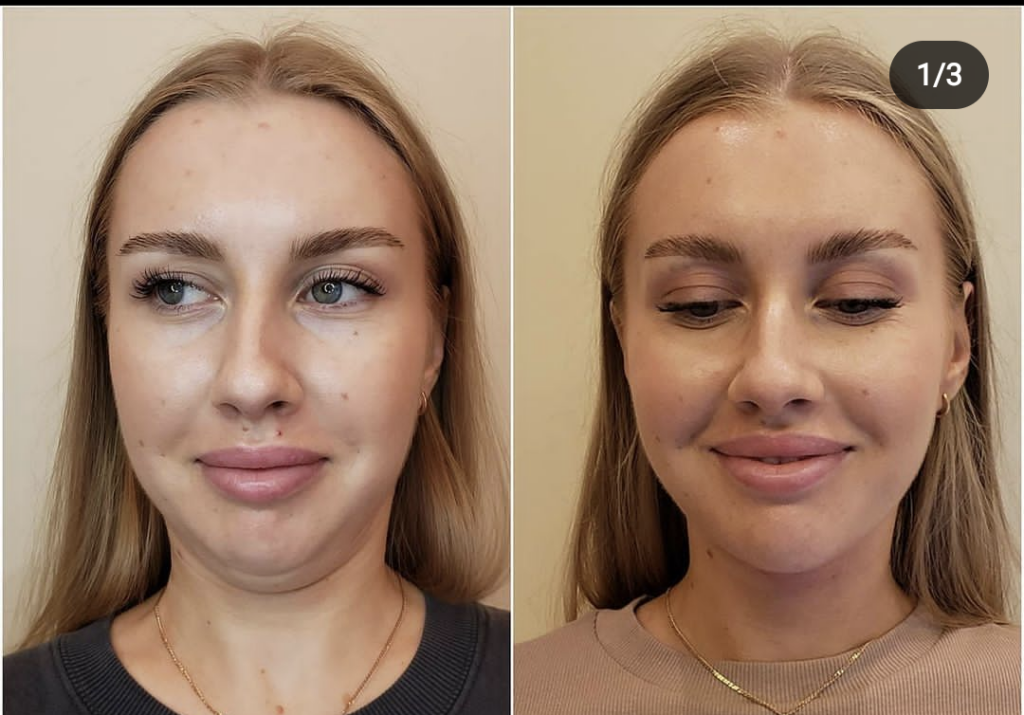 Masseter Slimming London - London Beauty Clinic