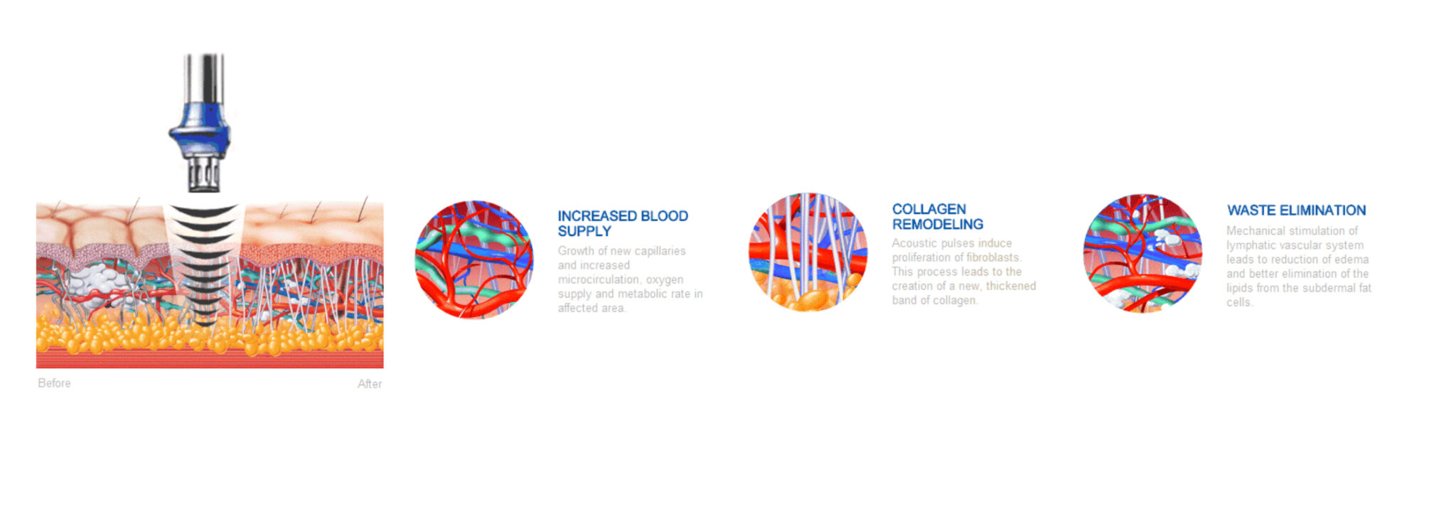 Shockwave Therapy London- London Beauty Clinic